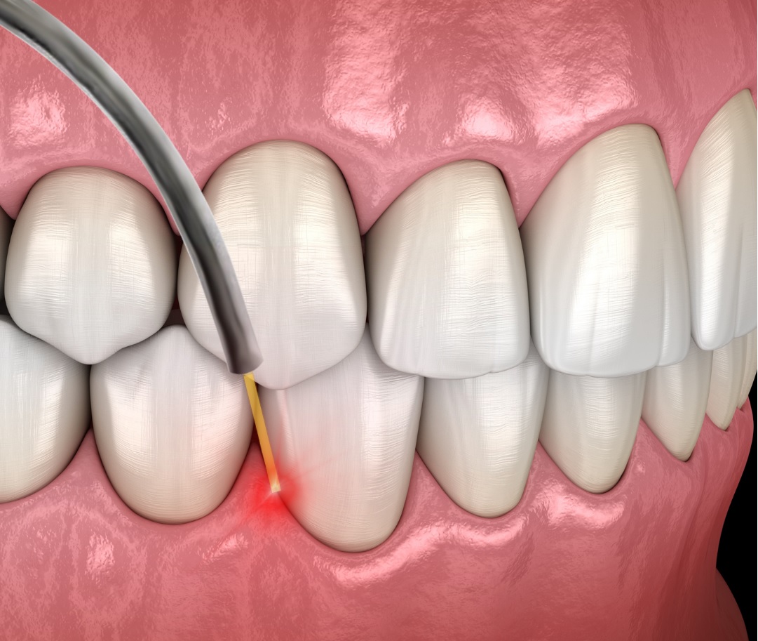 Laser Gum Surgery Genuine LANAP Laser Gum Treatment